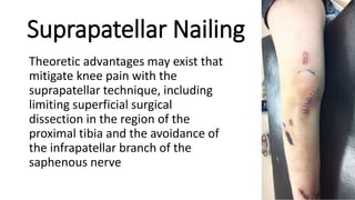 200330 Controversies in the intramedullary nailing of tibia | PPTX