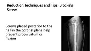 200330 Controversies in the intramedullary nailing of tibia | PPTX
