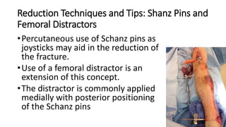 200330 Controversies in the intramedullary nailing of tibia | PPTX
