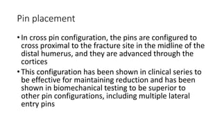200331 Evolving concepts in treatment of supracondylar fractures in ...