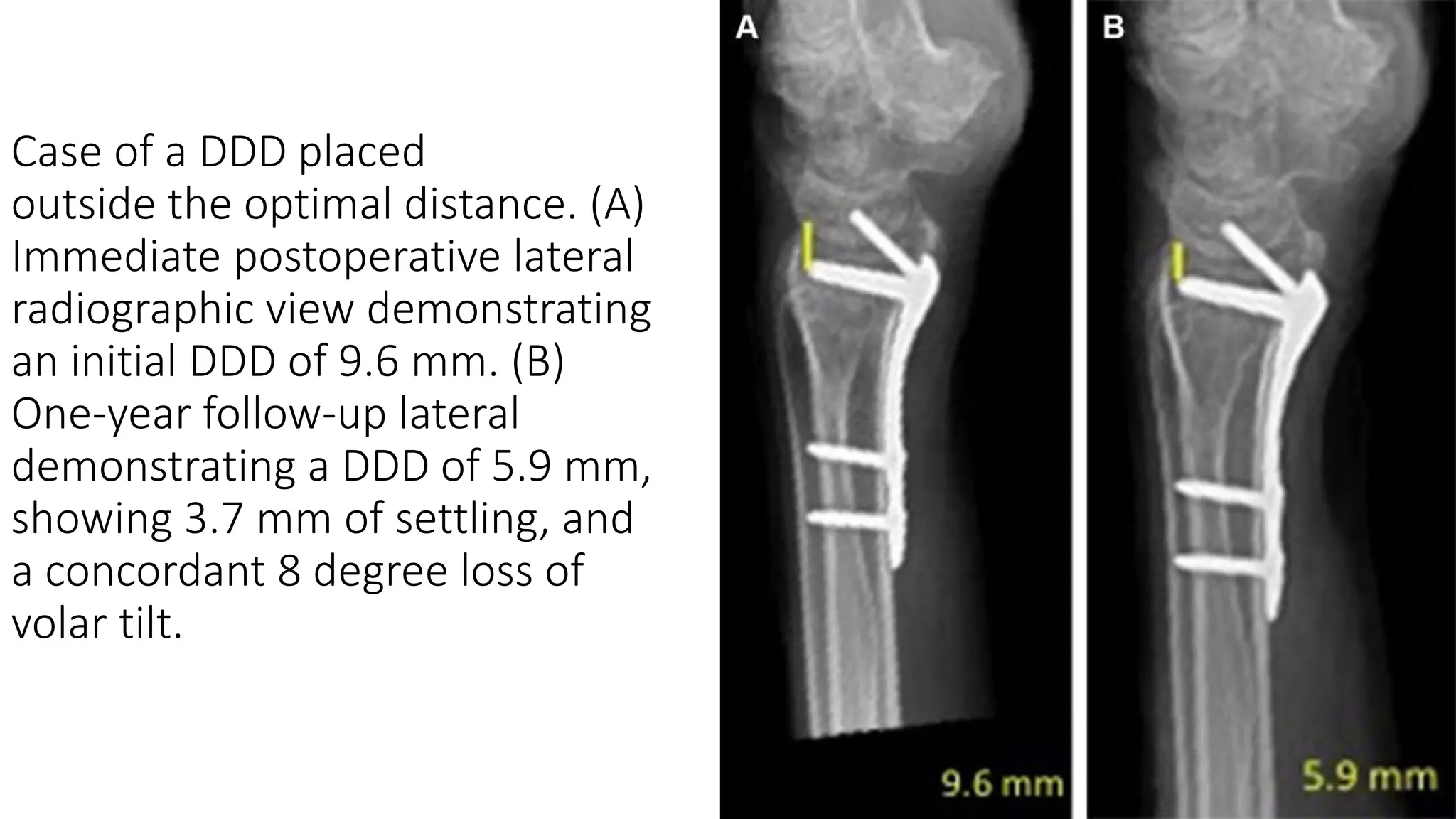 200331 Volar plate fixation for distal radius | PPTX