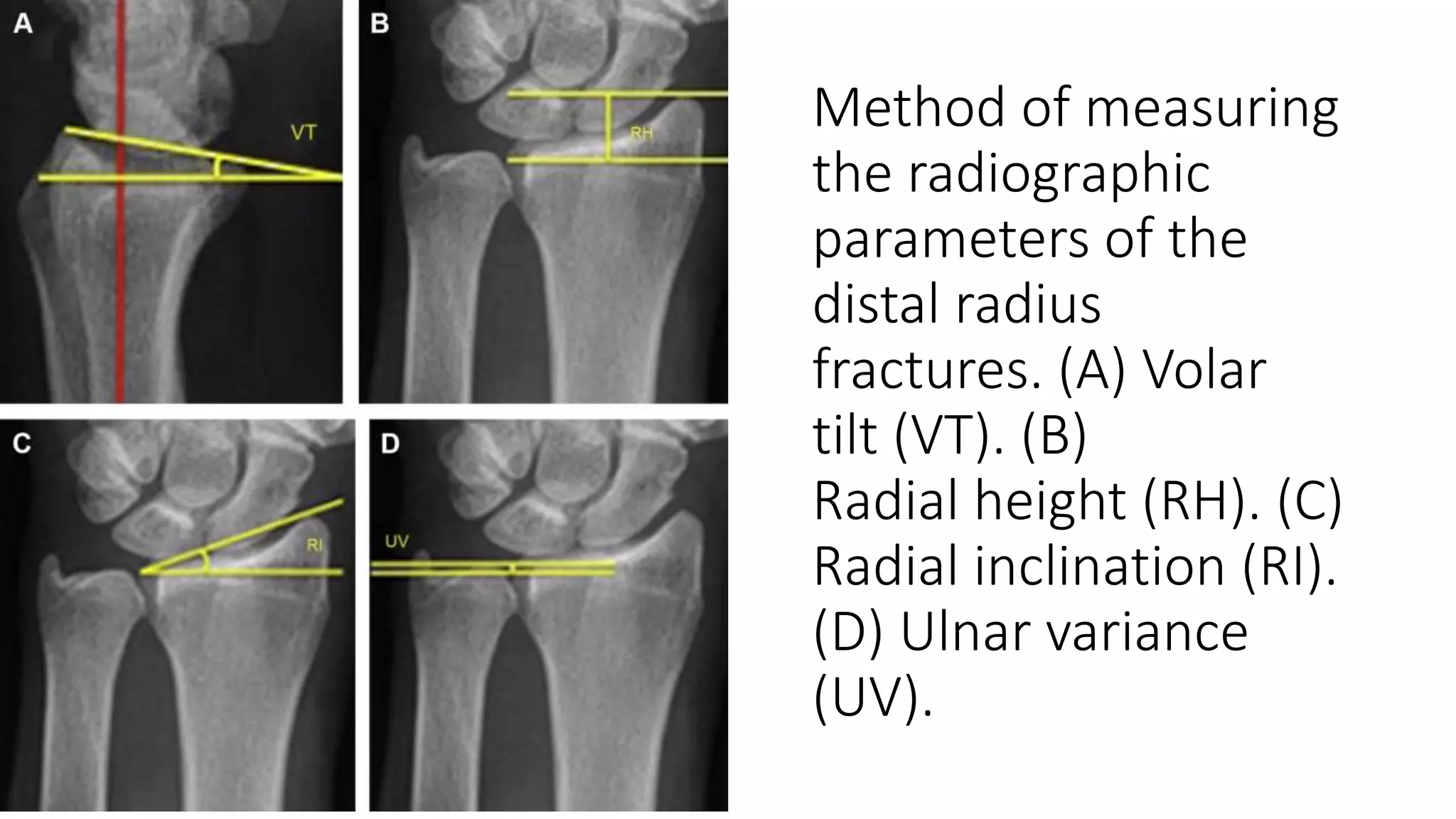200331 Volar plate fixation for distal radius | PPTX