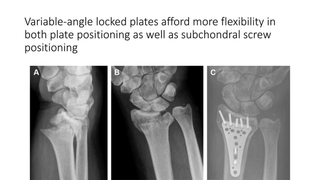 200331 Volar plate fixation for distal radius | PPTX | Death, Injury ...
