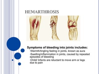 Student Work Hemophilia | PPT