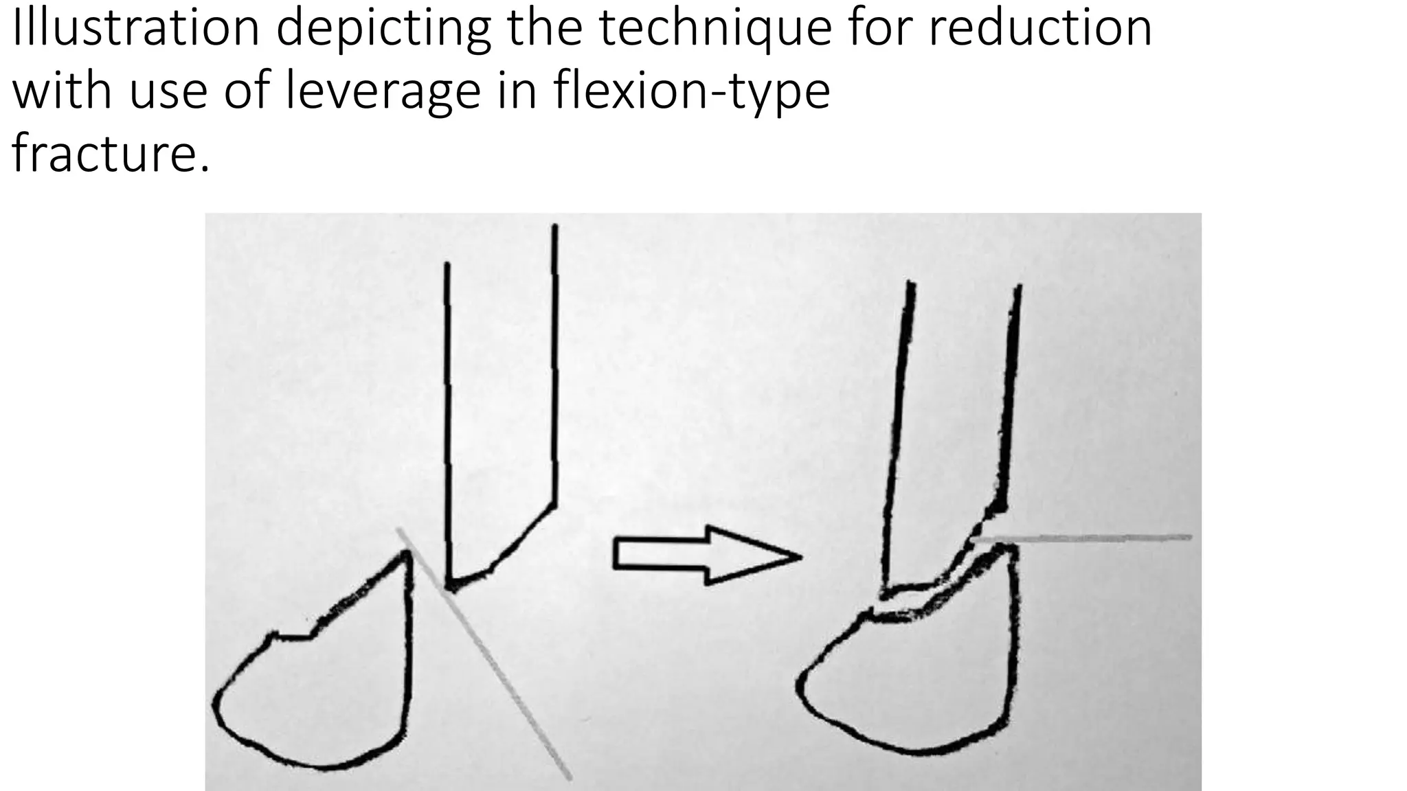 200402 Pediatric Gartland type IV Supracondylar humeral fractures | PPT