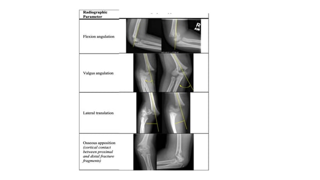 200402 Pediatric Gartland type IV Supracondylar humeral fractures | PPT