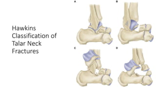 200421 Fractures of the talus | PPTX