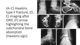 200421 Fractures of the talus | PPTX