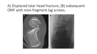200421 Fractures of the talus | PPT
