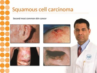 SkinCancer and its description about.ppt