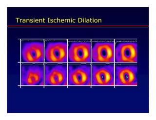 Redefining the Transient Ischemic Dilation Ratio | PDF