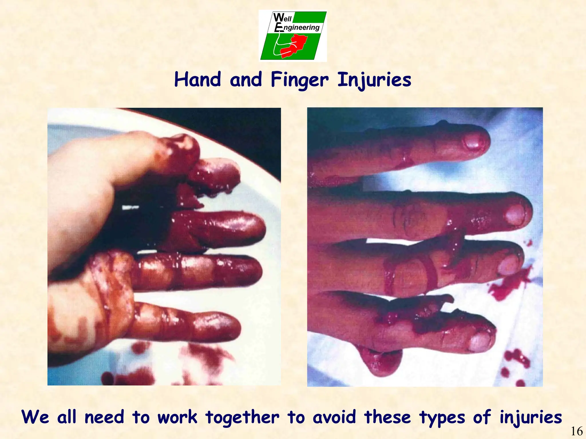 Hands & Fingers Injury Prevention Campaign.ppt
