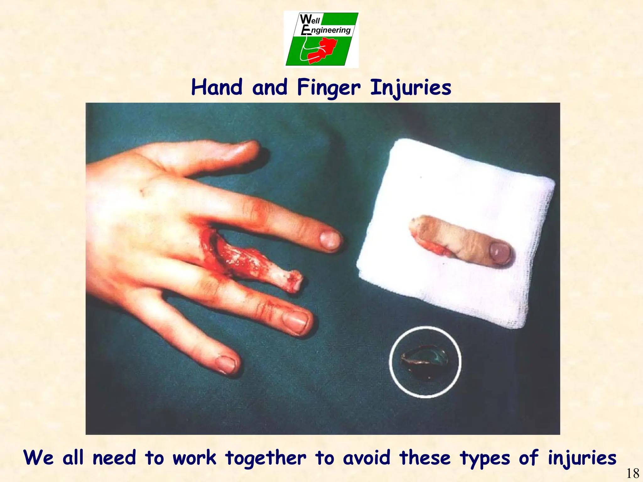 Hands & Fingers Injury Prevention Campaign.ppt