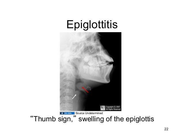 Thumbprint Sign Epiglottitis