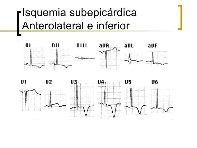 ekg isquemia_lesion_e_infarto_ekg