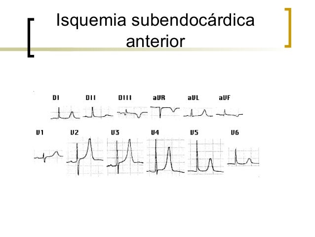 ekg isquemia_lesion_e_infarto_ekg
