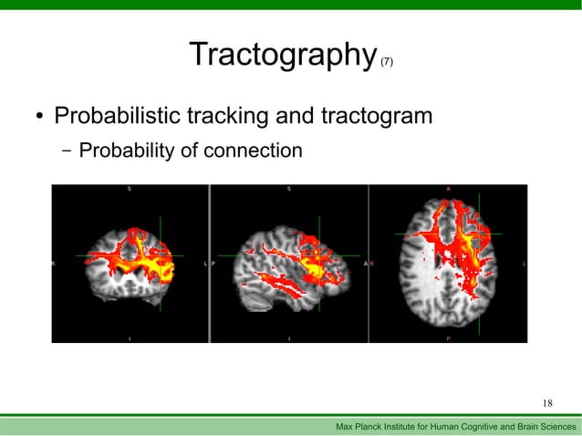 Diffusion MRI, Tractography,and Connectivity: what machine learning can ...