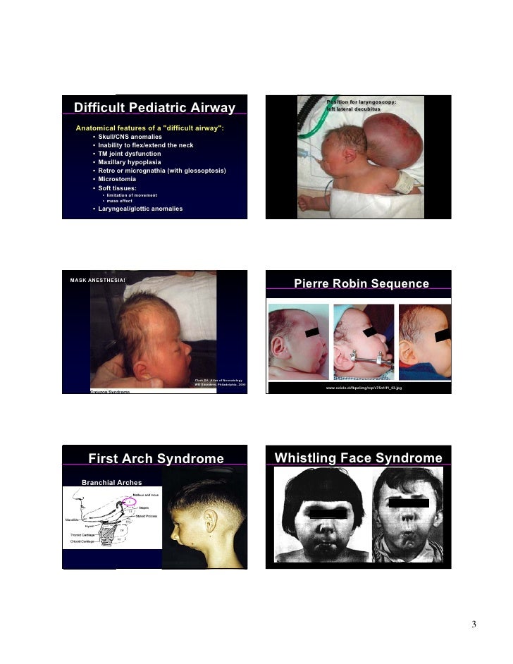 Managing the Difficult Pediatric Airway