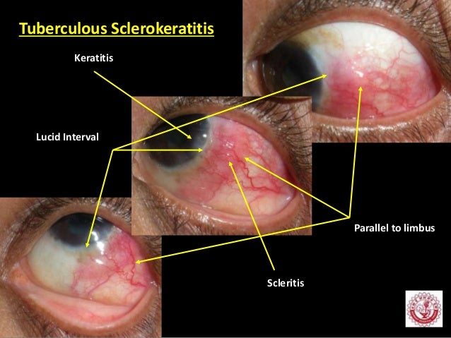 Tuberculous Scleritis Vs. Anca-Positive Scleritis