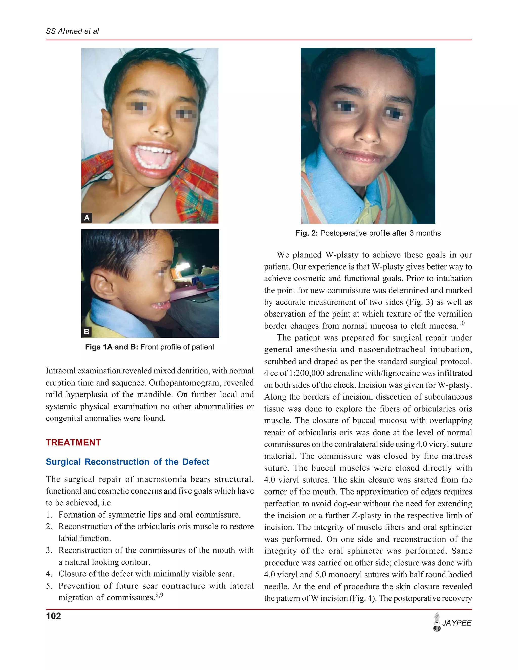 2010 ahmed-bilateral transverse facial cleft as an isolated and ...