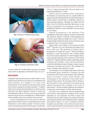 2010 ahmed-bilateral transverse facial cleft as an isolated and asyndromic deformity | PDF