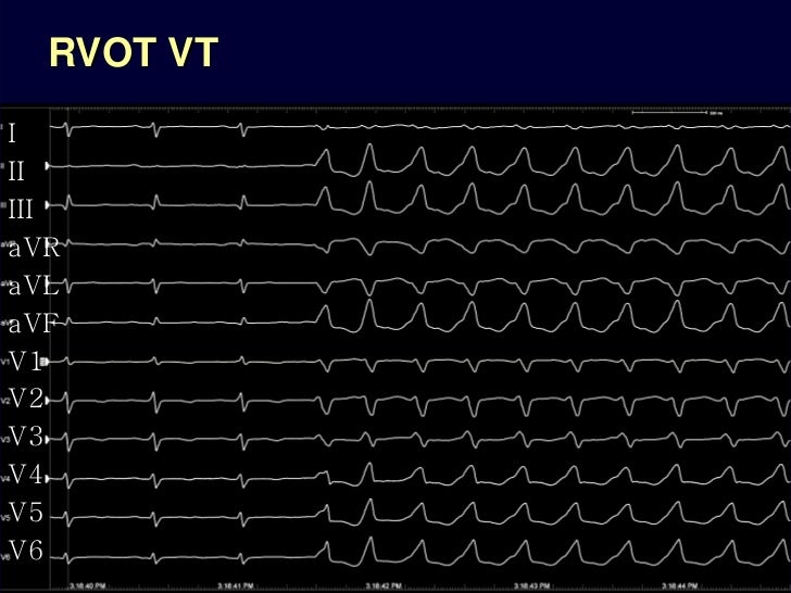 Ventricular tachycardia_lecture