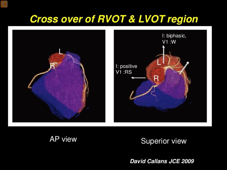 Ventricular tachycardia_lecture