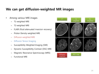 Diffusion Weighted MRI (2011-09-29 이정원) | PPTX
