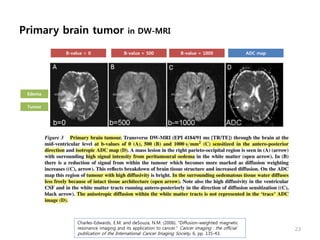 Diffusion Weighted MRI (2011-09-29 이정원) | PPTX