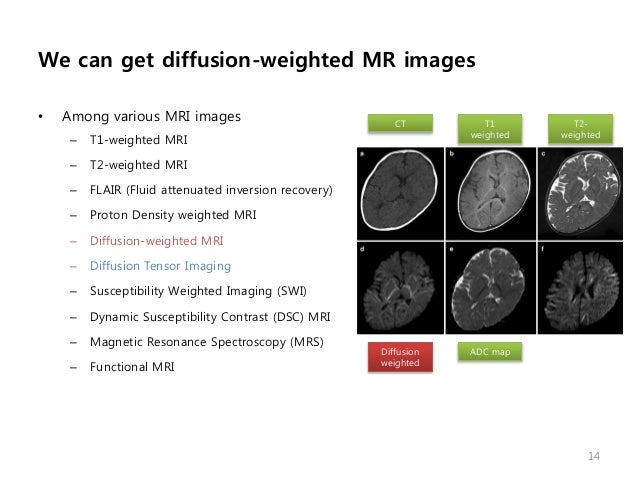 Diffusion Weighted MRI (2011-09-29 이정원)