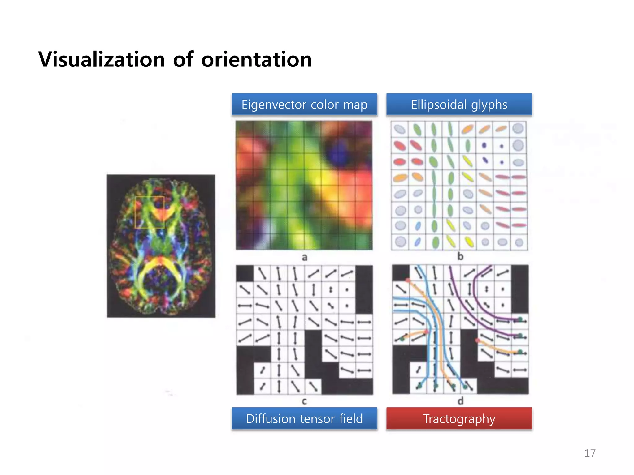 Diffusion Tensor Imaging (2011-10-04 이정원) | PPTX