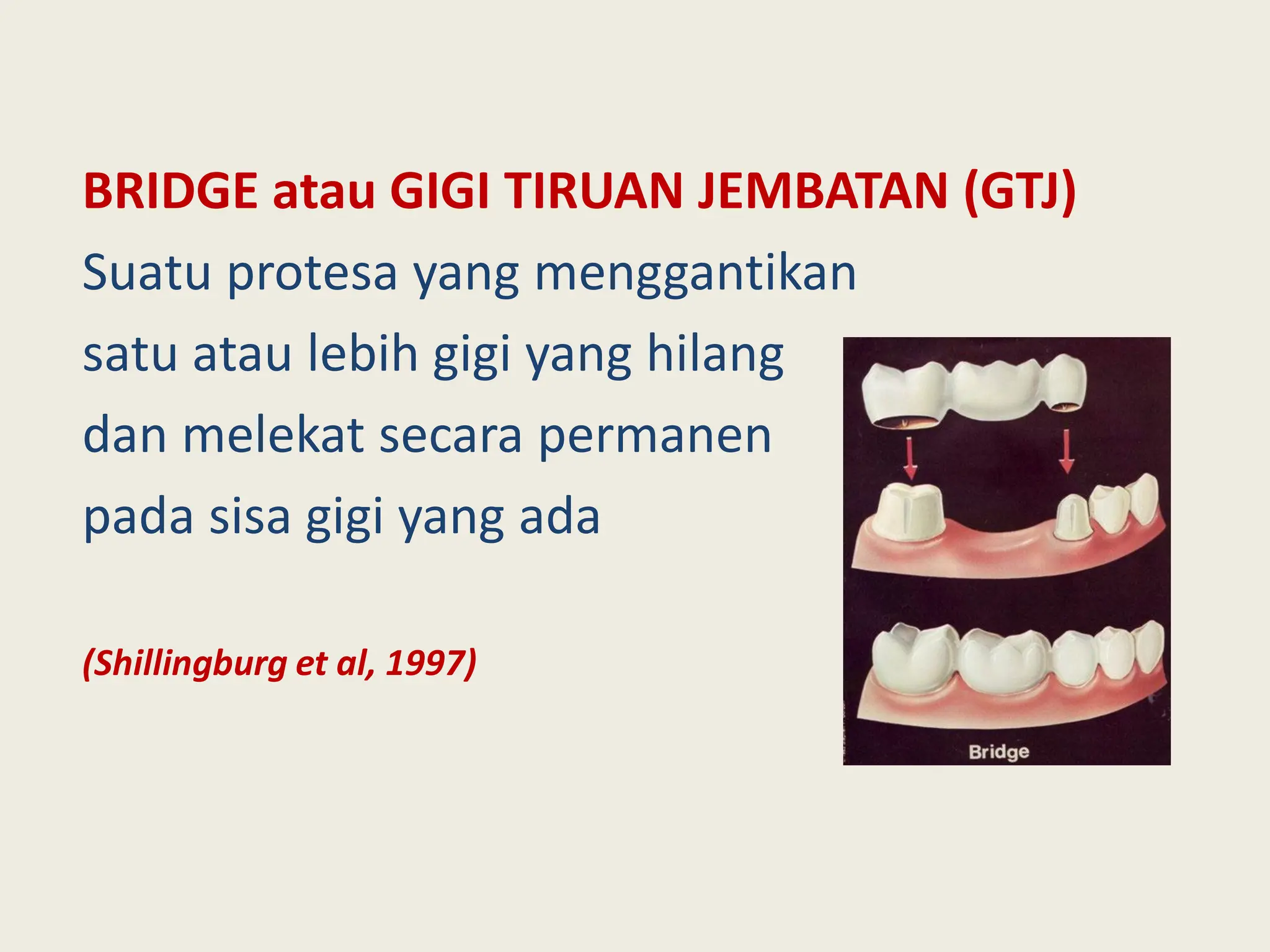 prinsip preparasi dalam pembuatan gigi tiruan jembatan | PDF