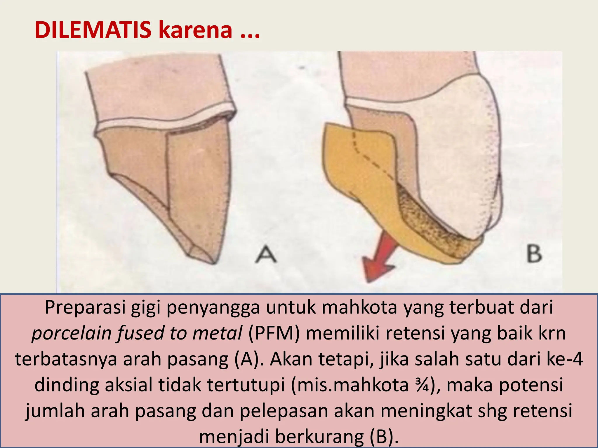 prinsip preparasi dalam pembuatan gigi tiruan jembatan | PDF