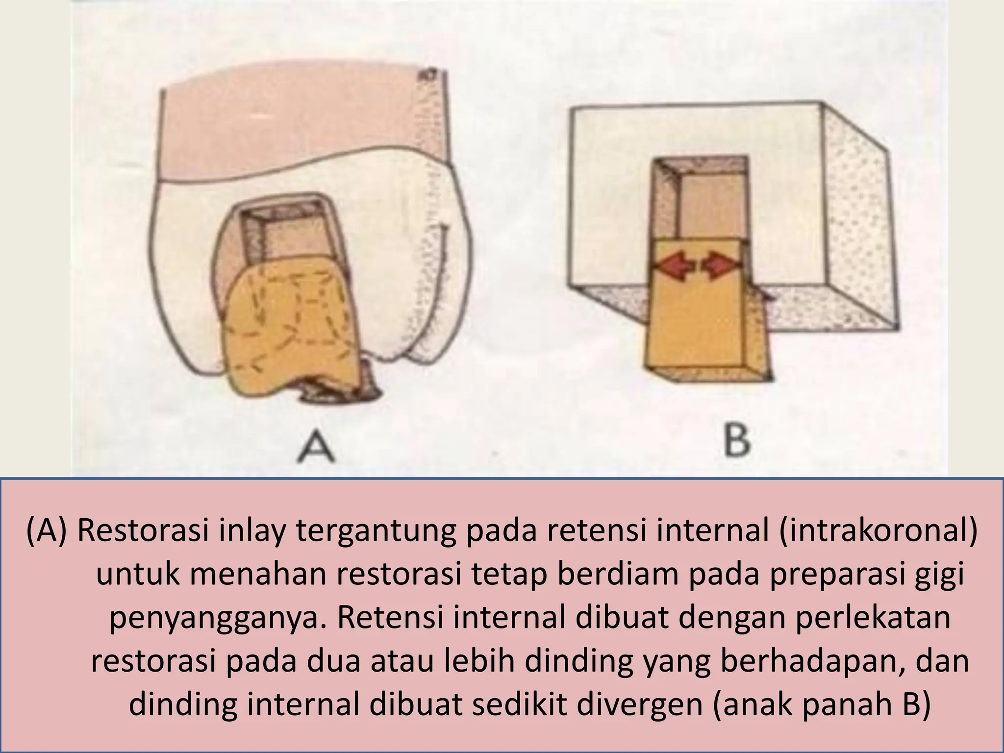 prinsip preparasi dalam pembuatan gigi tiruan jembatan | PDF