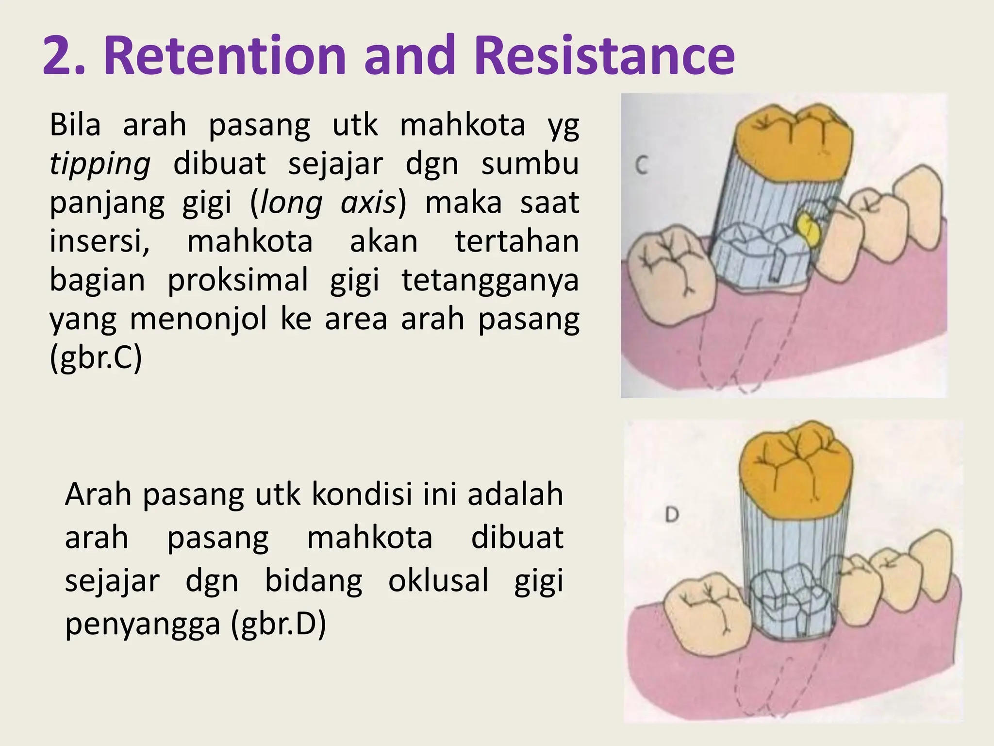 prinsip preparasi dalam pembuatan gigi tiruan jembatan | PDF