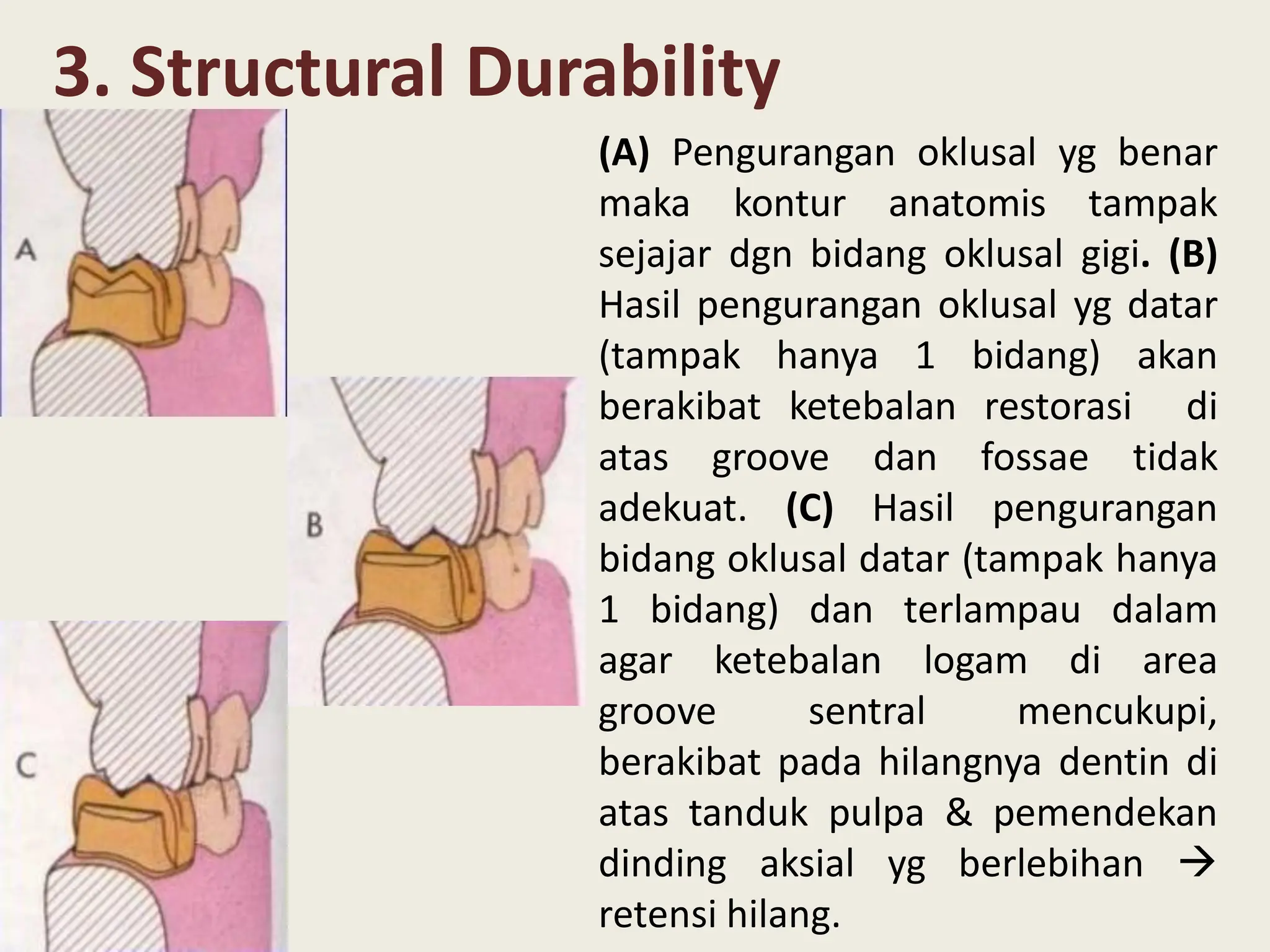 prinsip preparasi dalam pembuatan gigi tiruan jembatan | PDF