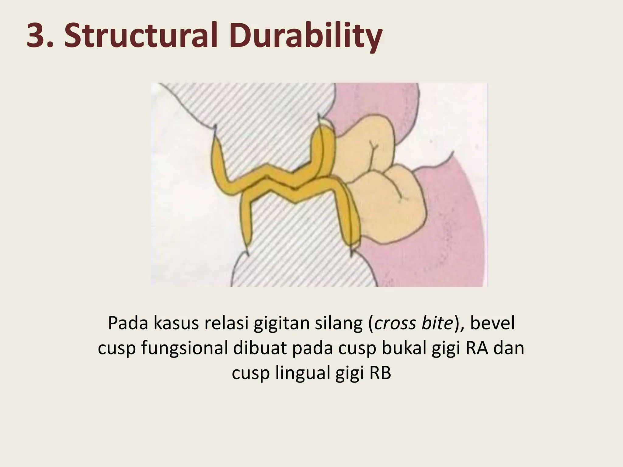prinsip preparasi dalam pembuatan gigi tiruan jembatan | PDF