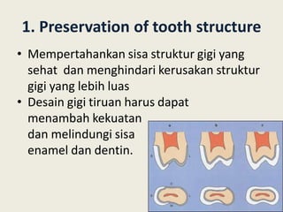 prinsip preparasi dalam pembuatan gigi tiruan jembatan | PDF