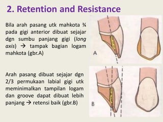 prinsip preparasi dalam pembuatan gigi tiruan jembatan | PDF