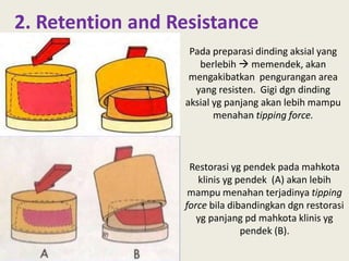 prinsip preparasi dalam pembuatan gigi tiruan jembatan | PDF