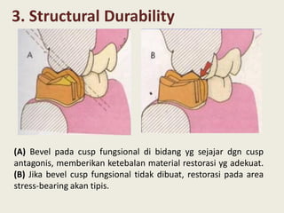 prinsip preparasi dalam pembuatan gigi tiruan jembatan | PDF