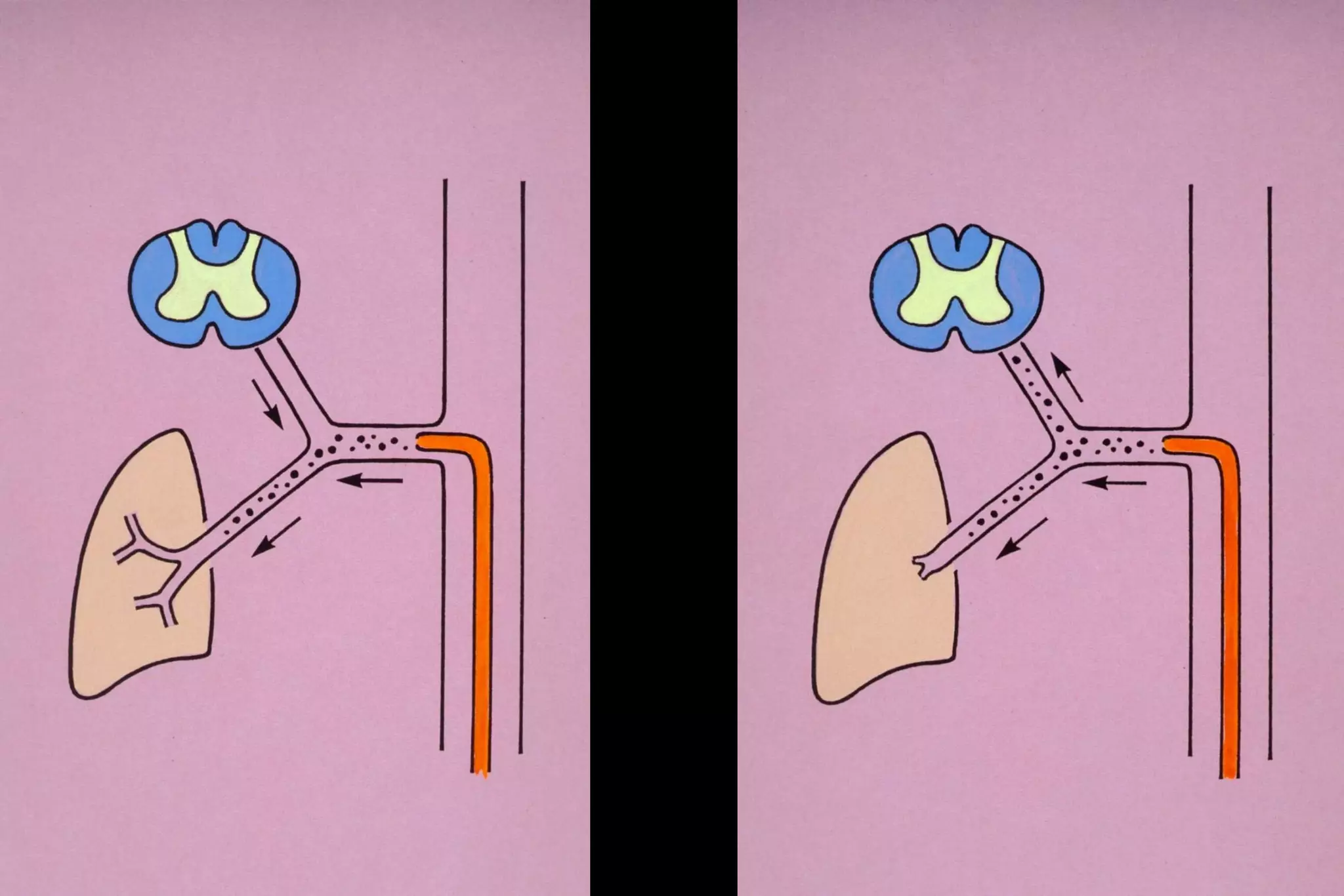 Bronchial embolisation to treat bleeding caused by chronic pulmonary ...