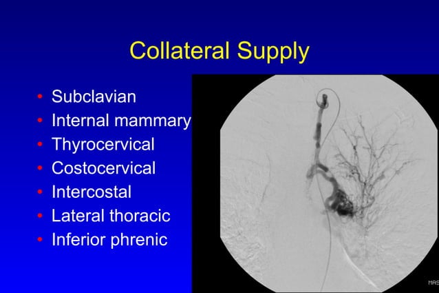 Bronchial embolisation to treat bleeding caused by chronic pulmonary ...