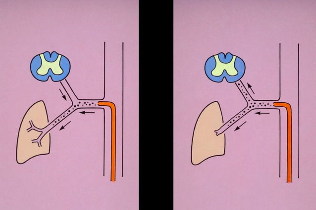 Bronchial embolisation to treat bleeding caused by chronic pulmonary ...