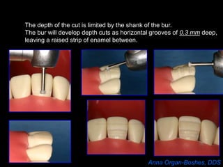 Veneer Preparation and Provisional | PPT