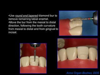Veneer Preparation and Provisional | PPT