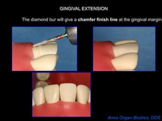 Veneer Preparation and Provisional | PPT