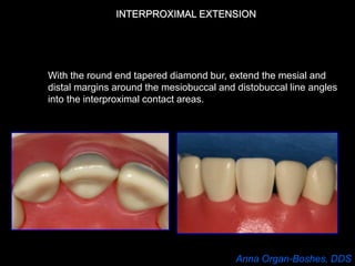Veneer Preparation and Provisional | PPT