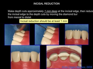 Veneer Preparation and Provisional | PPT