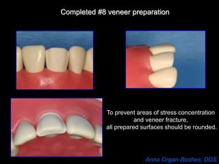 Veneer Preparation and Provisional | PPT